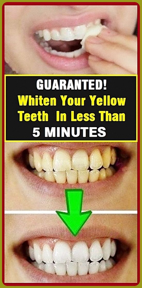 Guaranteed Whiten Your Yellow Teeth In Less Than 2 Minutes Healhty
