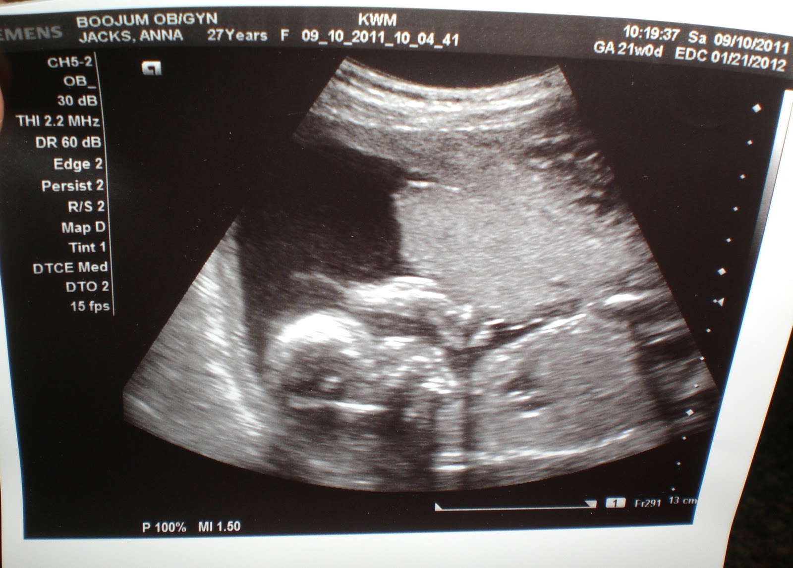 21 Weeks and Our Growth Scan