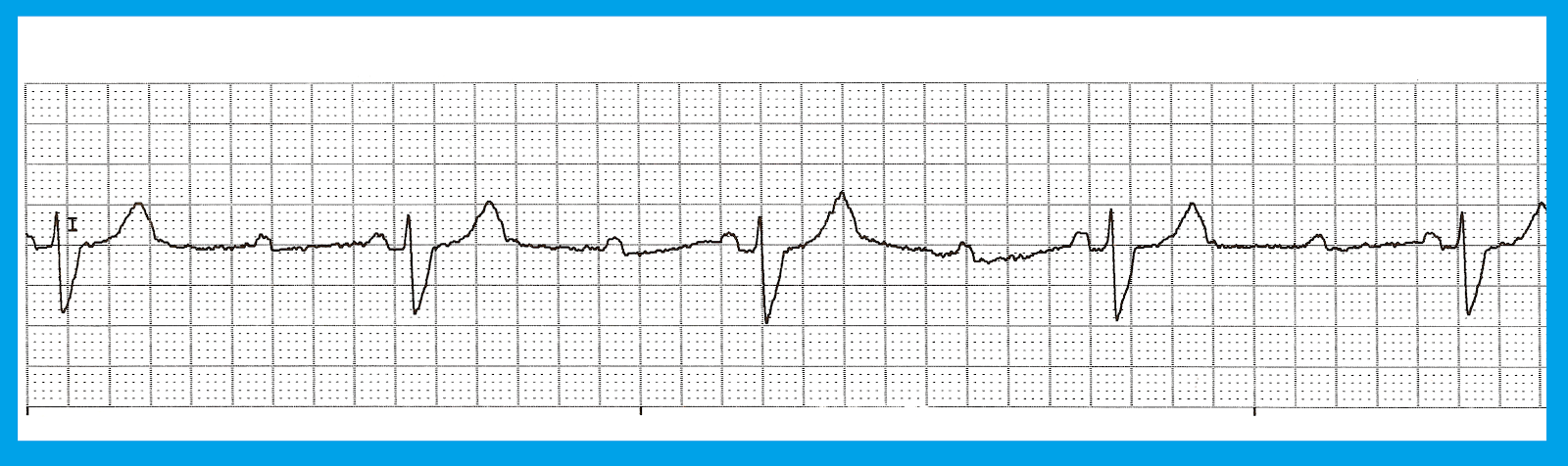 Basic EKG Rhythm Test 21 (Heart Block Challenge)