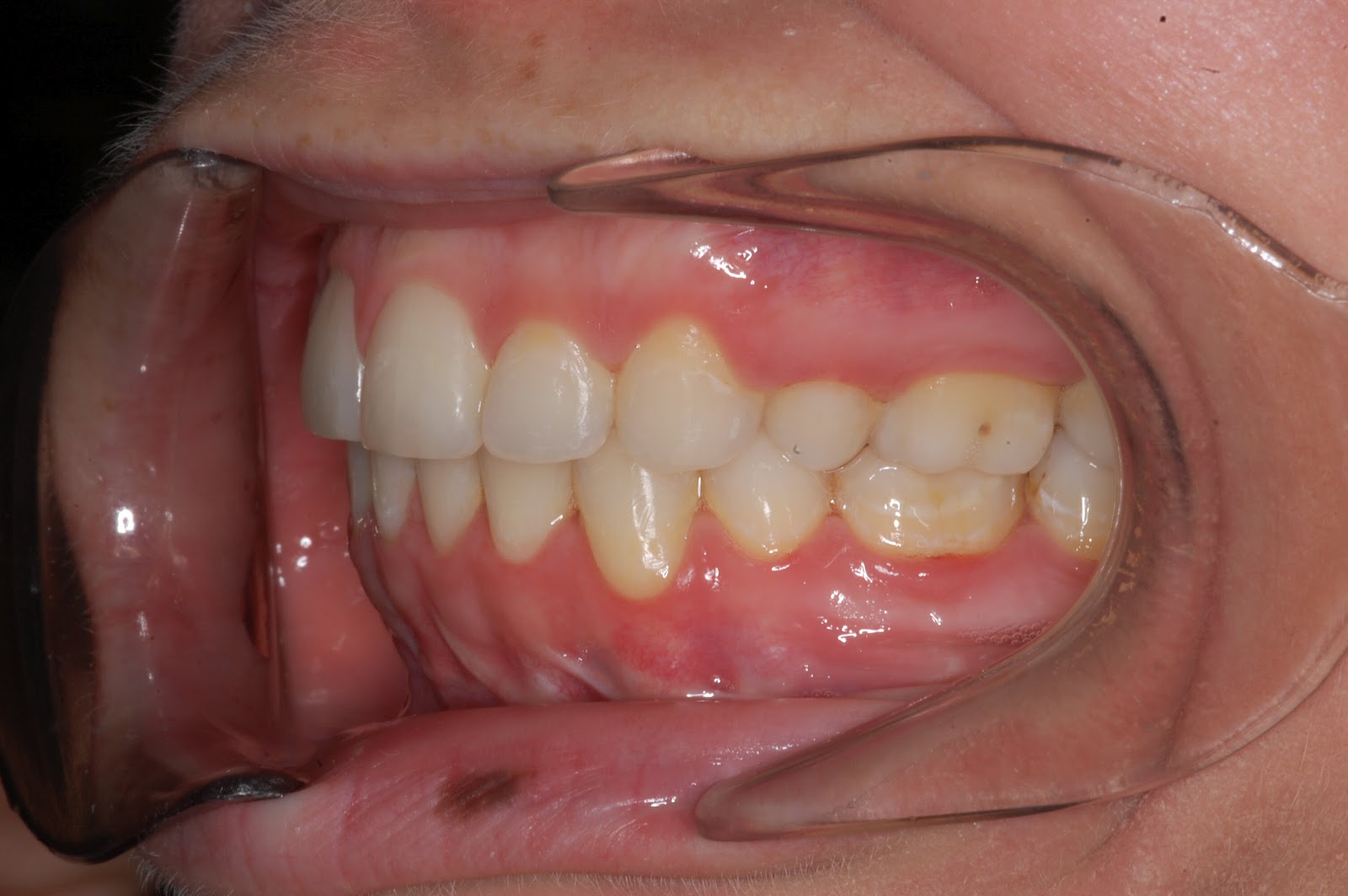 Truman Orthodontics: Orthognathic Surgery