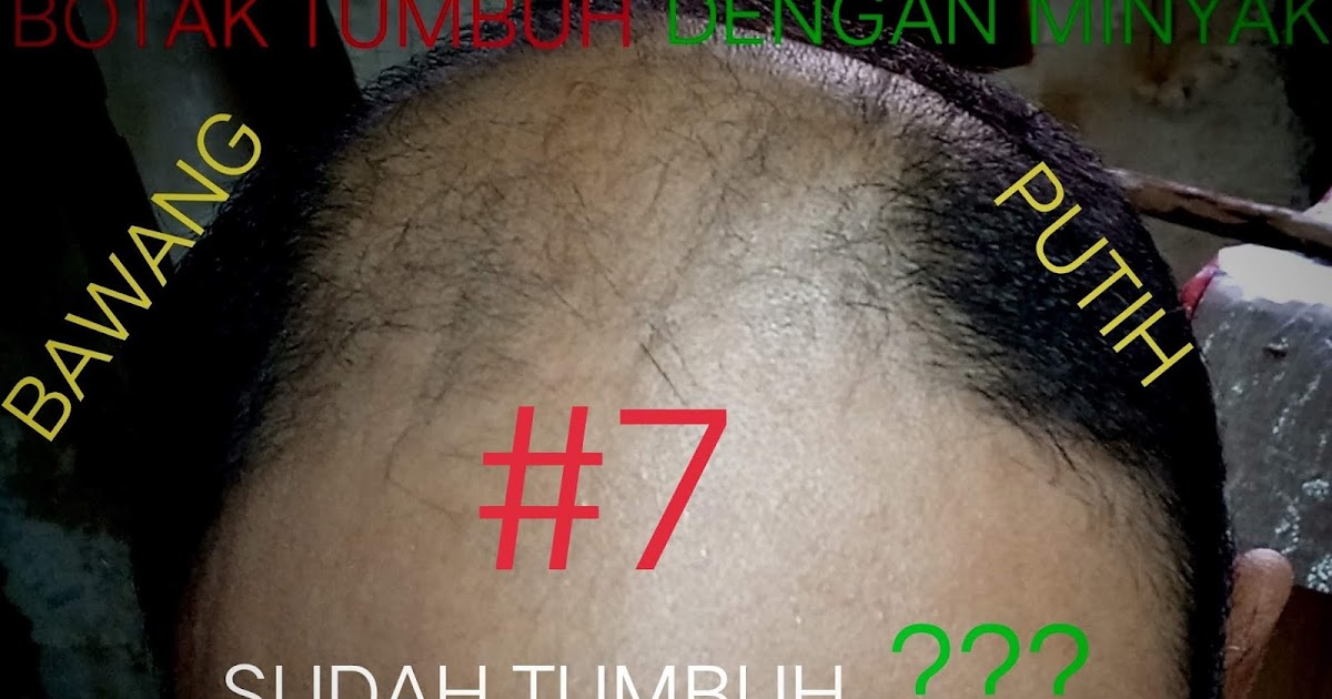 AdPohon: Strategy Mengajak Pria Rambut Pitak Menggunakan Garlic And ...