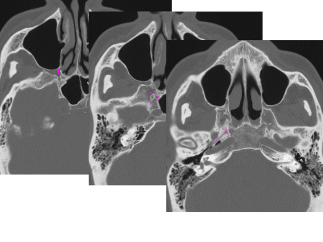 Skull and Spine: The Vidian Canal