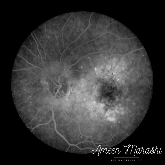 How would you follow up neovascular ARMD after loading dose?