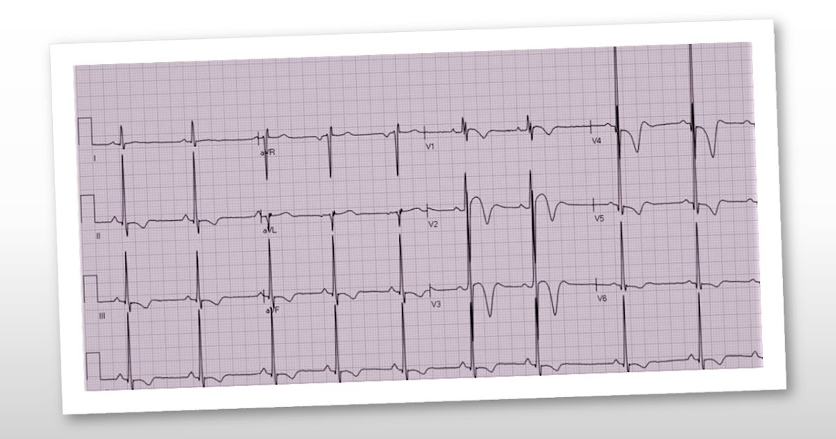 ECG en deportistas: Inversión inferolateral de la onda T ¿siempre ...