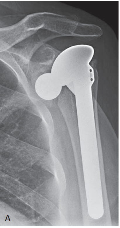 UW Shoulder and Elbow Academy: The importance of the humeral osteotomy ...