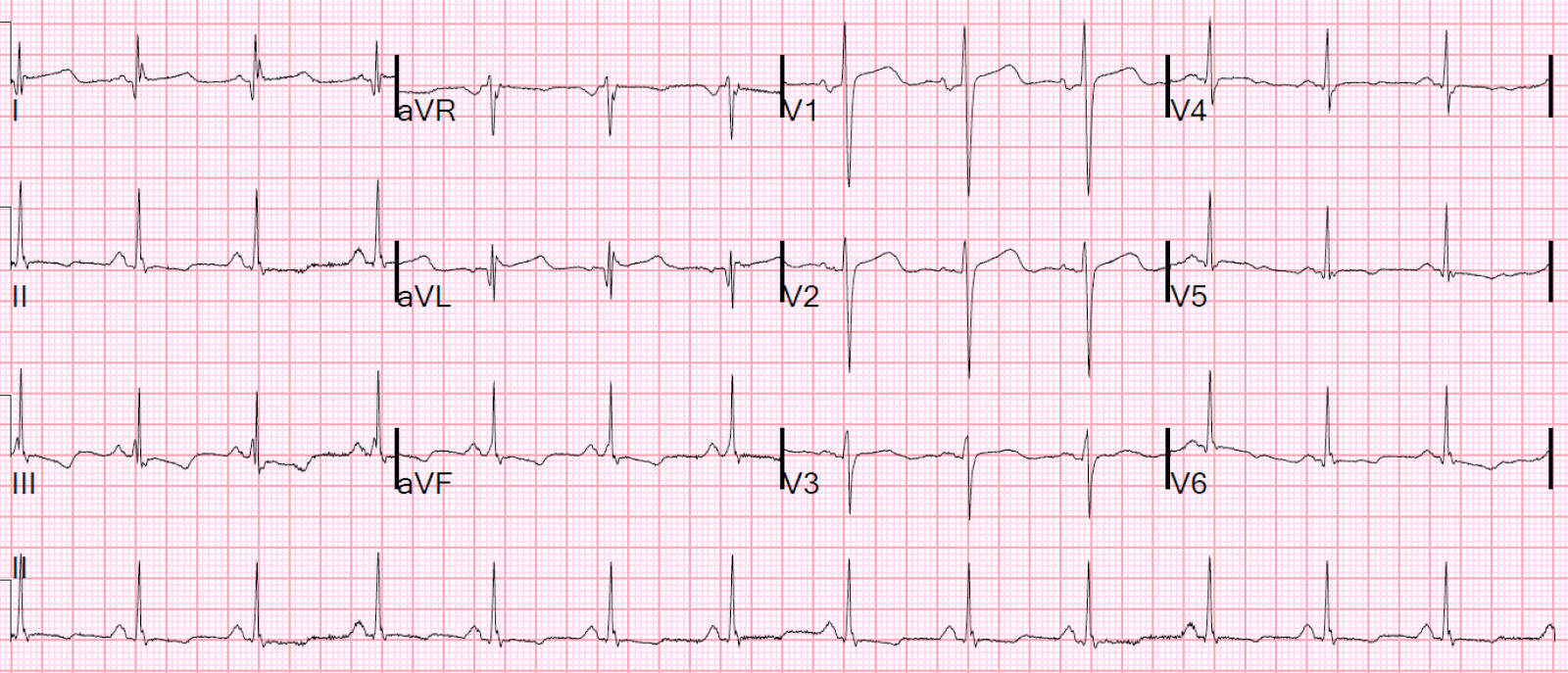 Dr. Smith's ECG Blog: Dyspnea and Convex ST elevation, Marked LVH, with ...