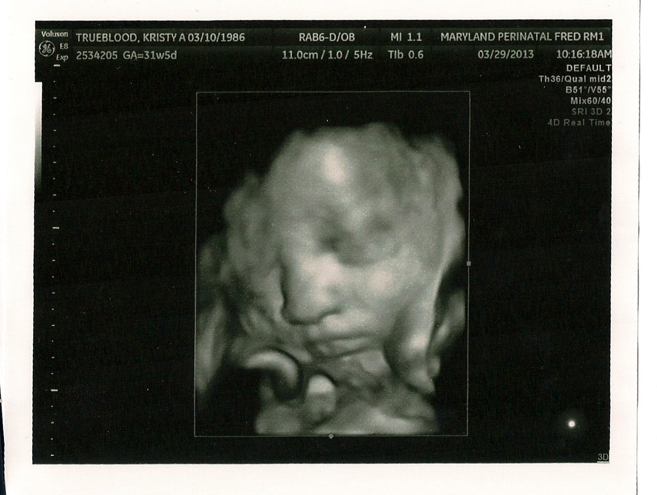 Jason and Kristy: 32 Week Growth Ultrasound