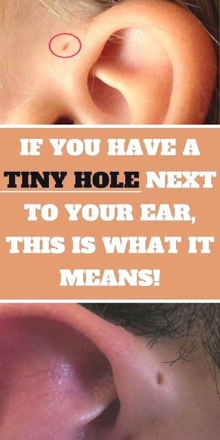if you have a tiny hole next to your ear,this is what it means ...