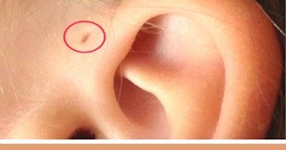 if you have a tiny hole next to your ear,this is what it means ...
