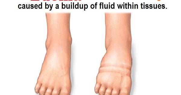 Difference between Pitting Edema and Non-Pitting Edema - The Scientific ...