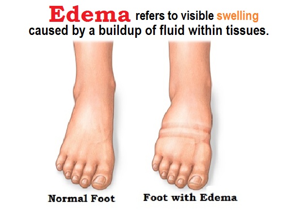 Difference between Pitting Edema and Non-Pitting Edema