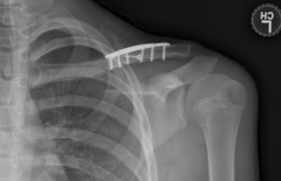 Young Athlete Center: Clavicle Fractures in Adolescents: Big Kids or ...