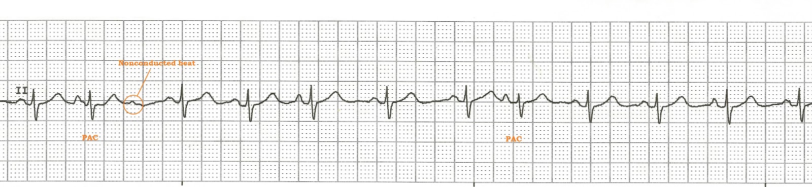 EKG Rhythm Strips 89