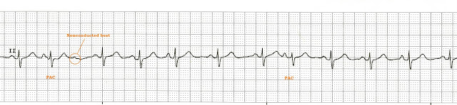 EKG Rhythm Strips 89