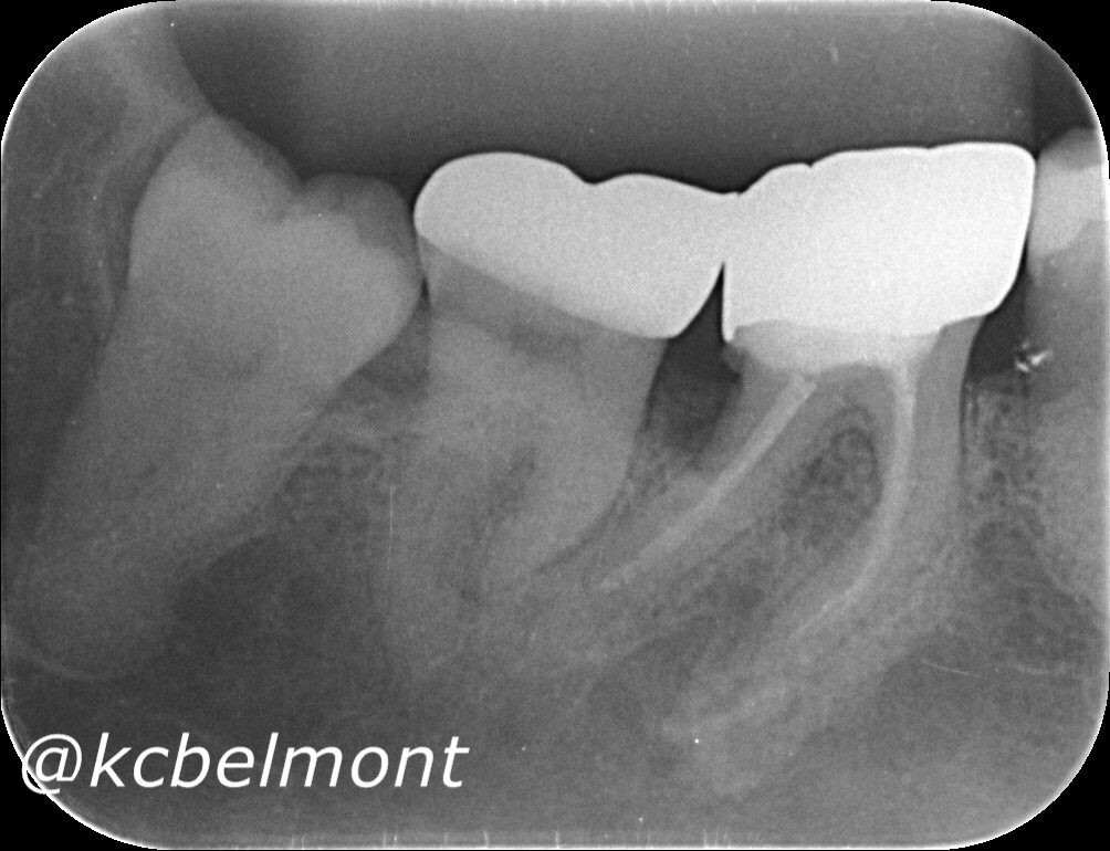 "Te vejo por dentro": Sequência de dilaceração radicular