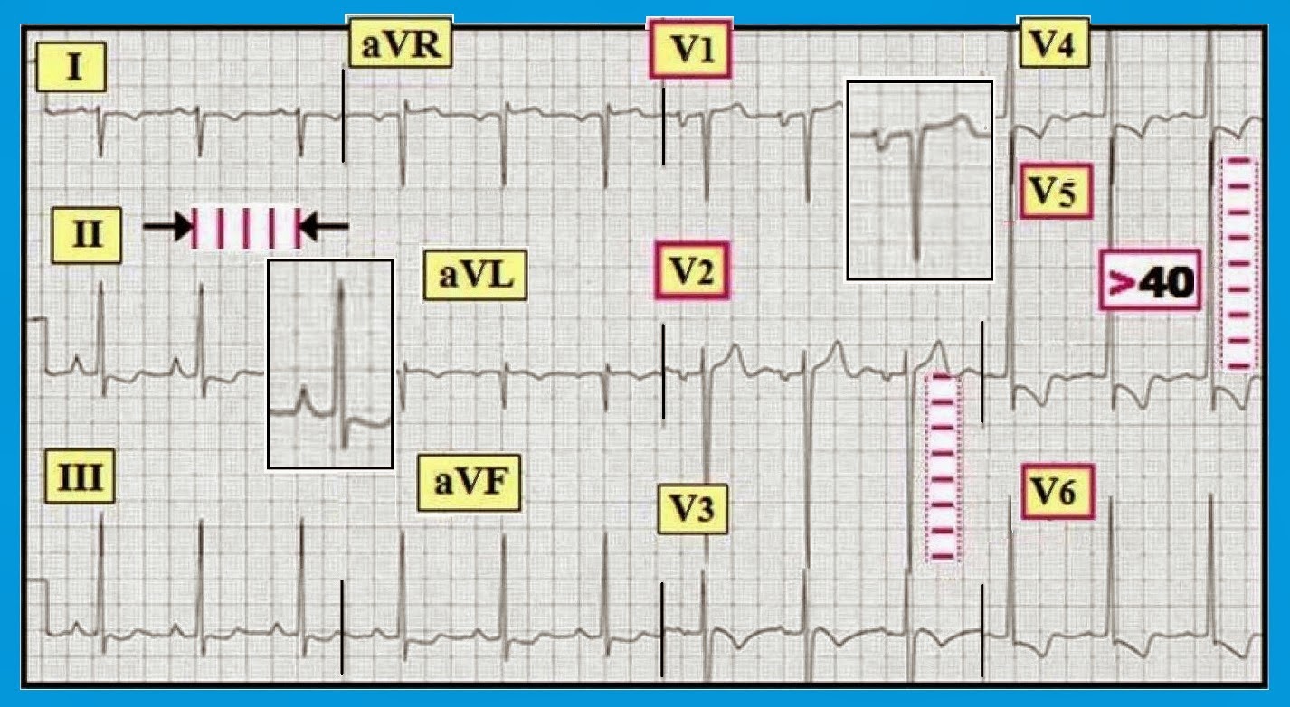 ECG Interpretation: ECG Blog #90 (Basic Concepts-3) – AXIS