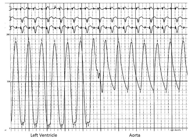 LEFT HEART CATHETERIZATION - pediagenosis