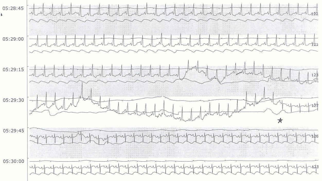 Pedi cardiology: EKG: Narrow Complex Tachycardia in a neonate