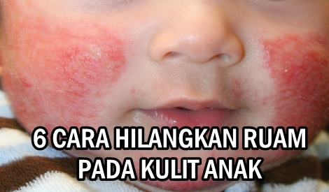 6 CARA HILANGKAN RUAM PADA KULIT ANAK, CUBA NI!