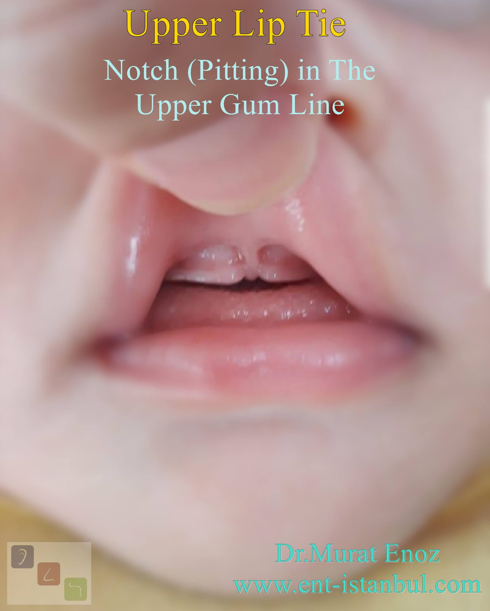 There Are Differences Of Opinion And Insufficient Information Among Physicians About Lip Tie
