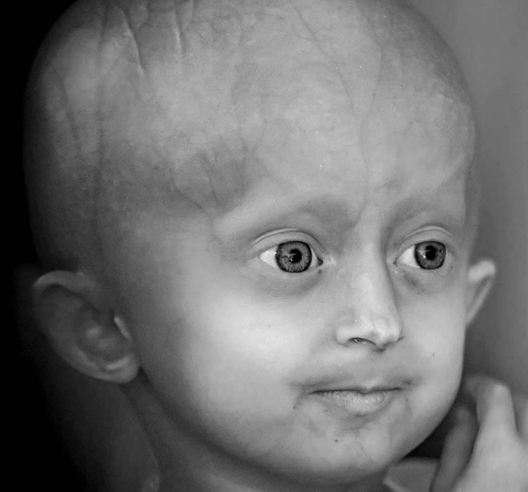 Medical Terms & Сlinical Сases : Hallermann-Streiff-François syndrome