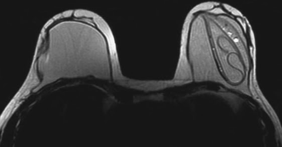 ABC Radiology Blog: MRI for Imaging Breast Implants