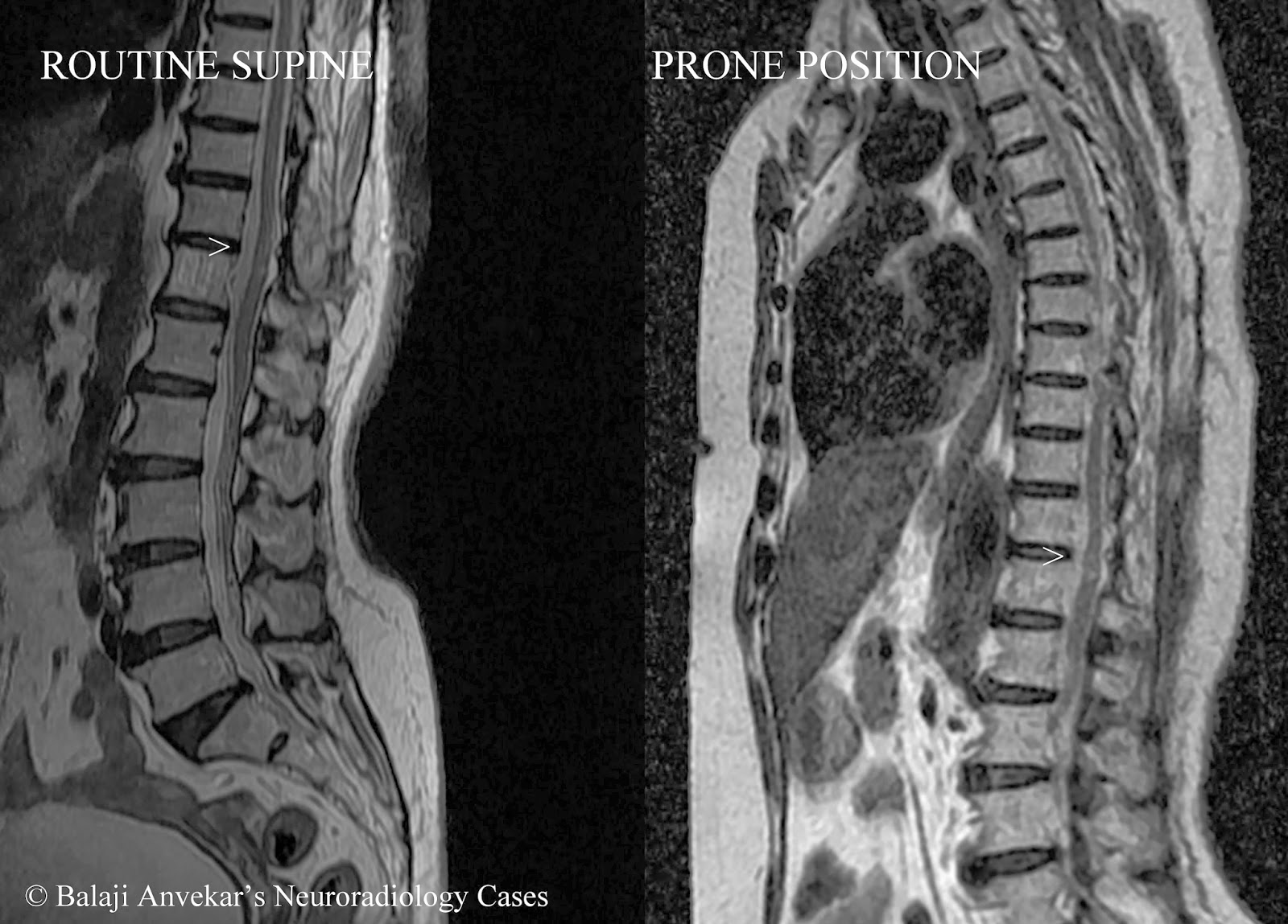 Dr Balaji Anvekar FRCR: Post Laminectomy site Adhesion / Herniation of ...