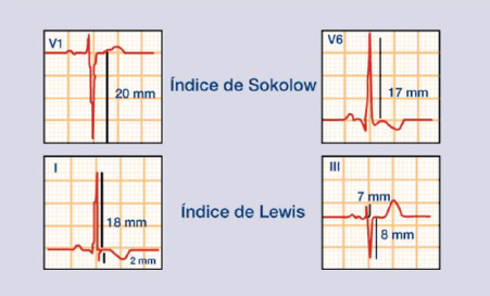 indice sokolow lewis