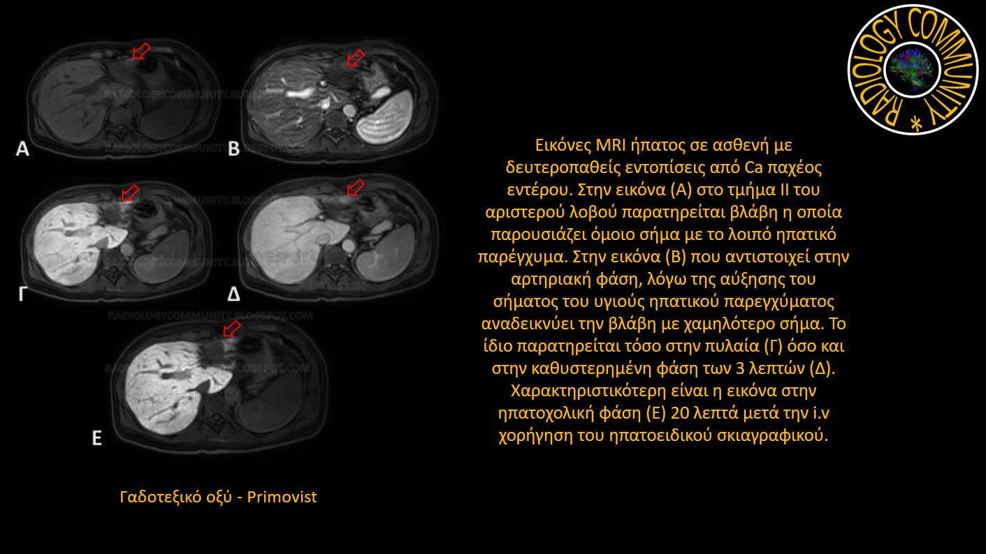 Radiology Community: MRI Ήπατος με Ηπατοειδικά Μέσα Σκιαγραφικής Αντίθεσης.