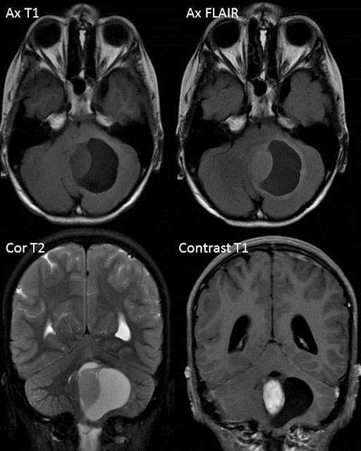 Radshare: PILOCYTIC ASTROCYTOMA