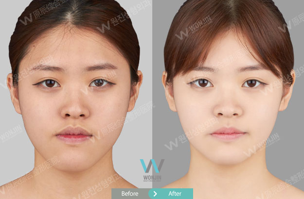 Mulut yang Maju dapat Diperbaiki dan Diobati dengan Operasi Dua Rahang