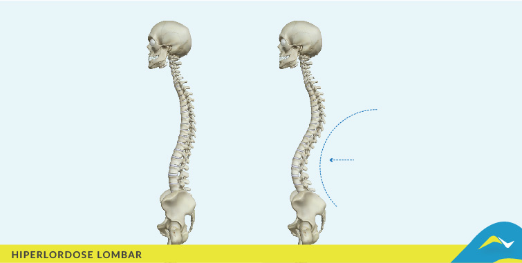 Patologias – Hiperlordose – Coach Carlos