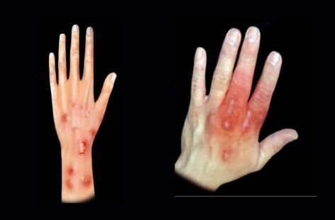 Mycobacterium marinum ~ Common Aquarium Fish Disease