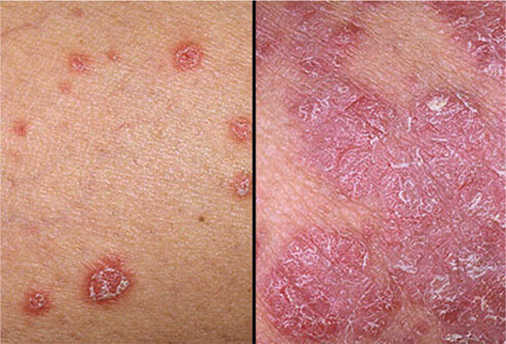 Papulosquamous disorders