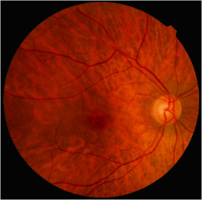 ESPACIO RETINA: Retinografía normal / Fondo senil.
