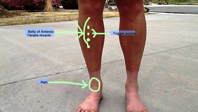 Cheryl MovingInBalance: Recovering from AR50M - Trigger Point therapy