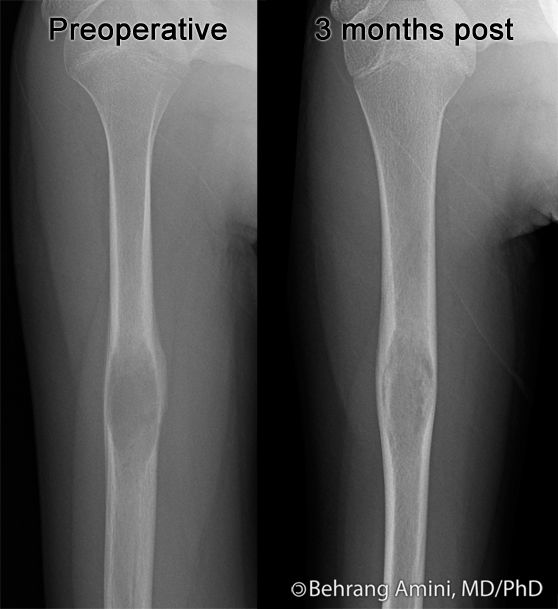Roentgen Ray Reader: Demineralized Bone Matrix Putty