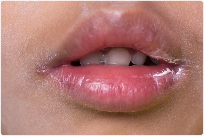 Angular Cheilitis Definition Causes And Treatment