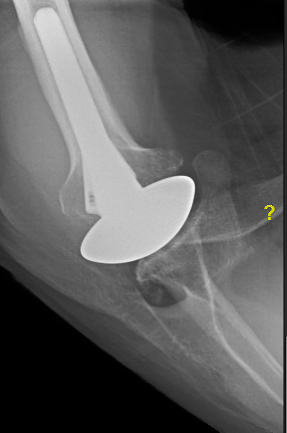 UW Shoulder and Elbow Academy: 44 year old with severe humeral head ...