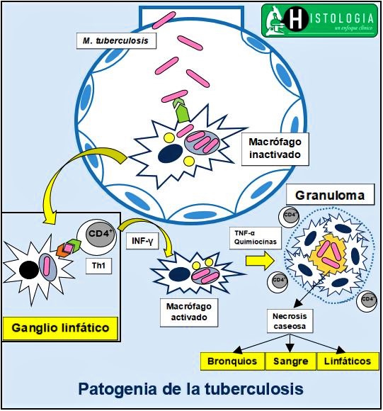 HISTOLOGÍA un enfoque clínico: TUBERCULOSIS