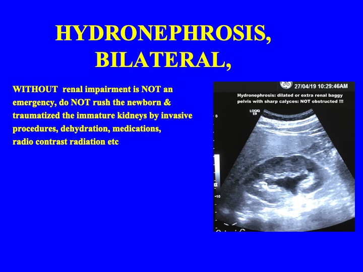 Kuching Urology古晉秘尿專科: Hydronephrosis in neonates & children Dr Lei ...