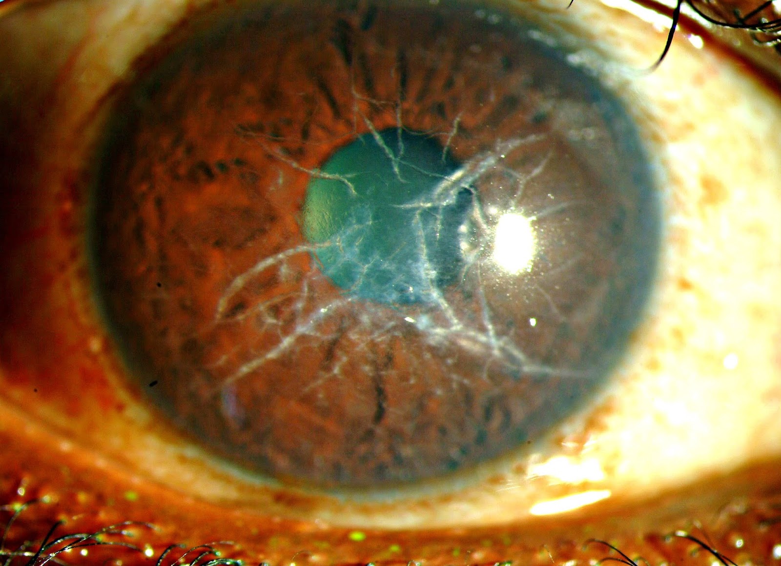¿ Distrofia corneal granular ? Características clínicas + Genética ...