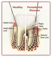Community Periodontal Index for Treatment Needs (CPITN) - Education ...