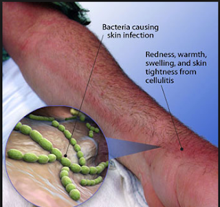 Cellulitis - IkiDay
