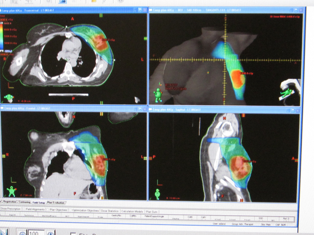Chemo Transit: Radiation Therapy finally starts