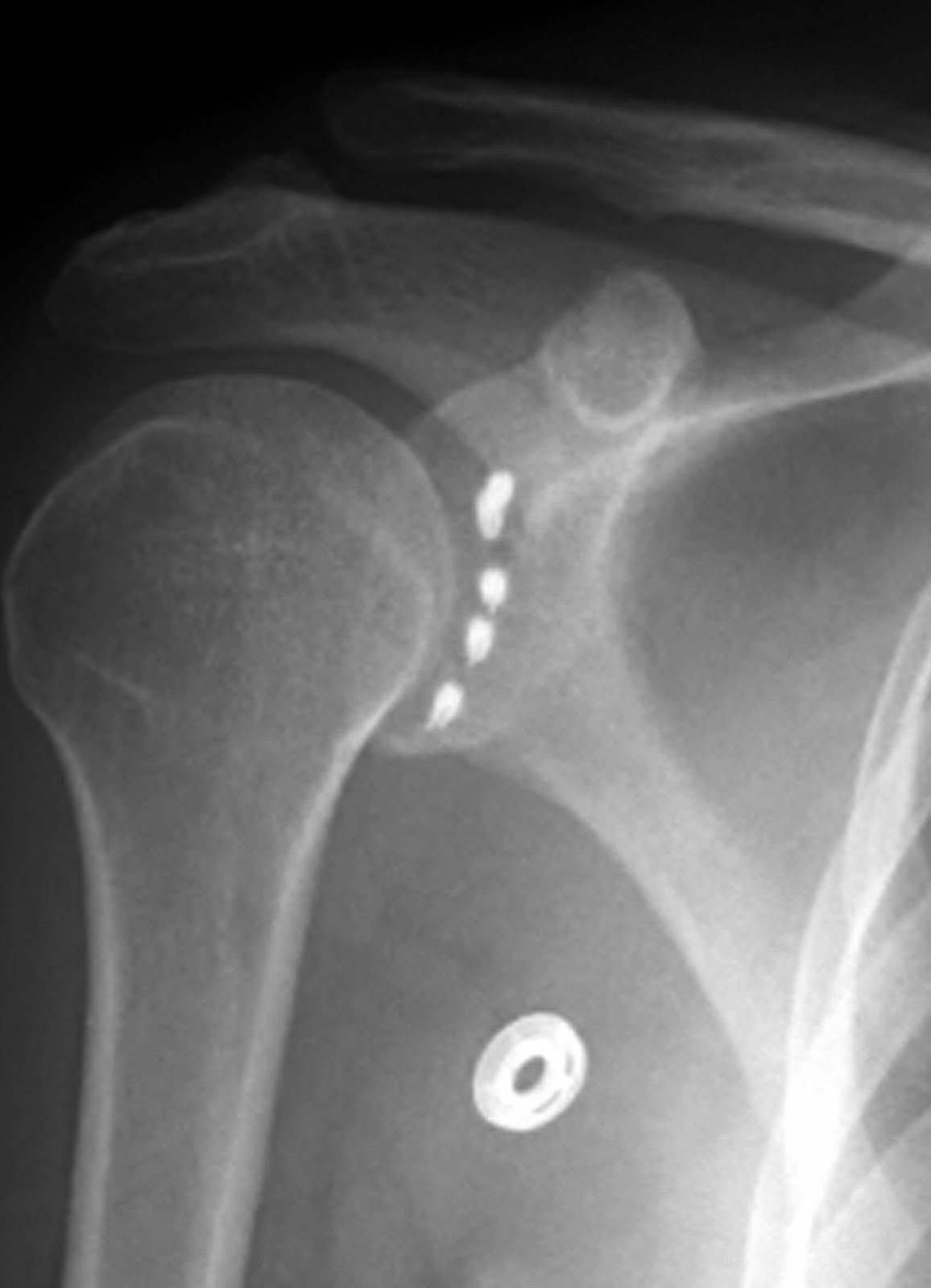 Shoulder Dislocation After Labrum Repair at Albert Glover blog