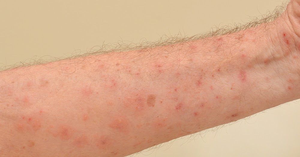 4 Causes of the appearance of red spots on the skin