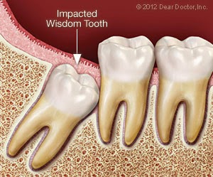 Impacted Wisdom Tooth Removal | Dental Dentist