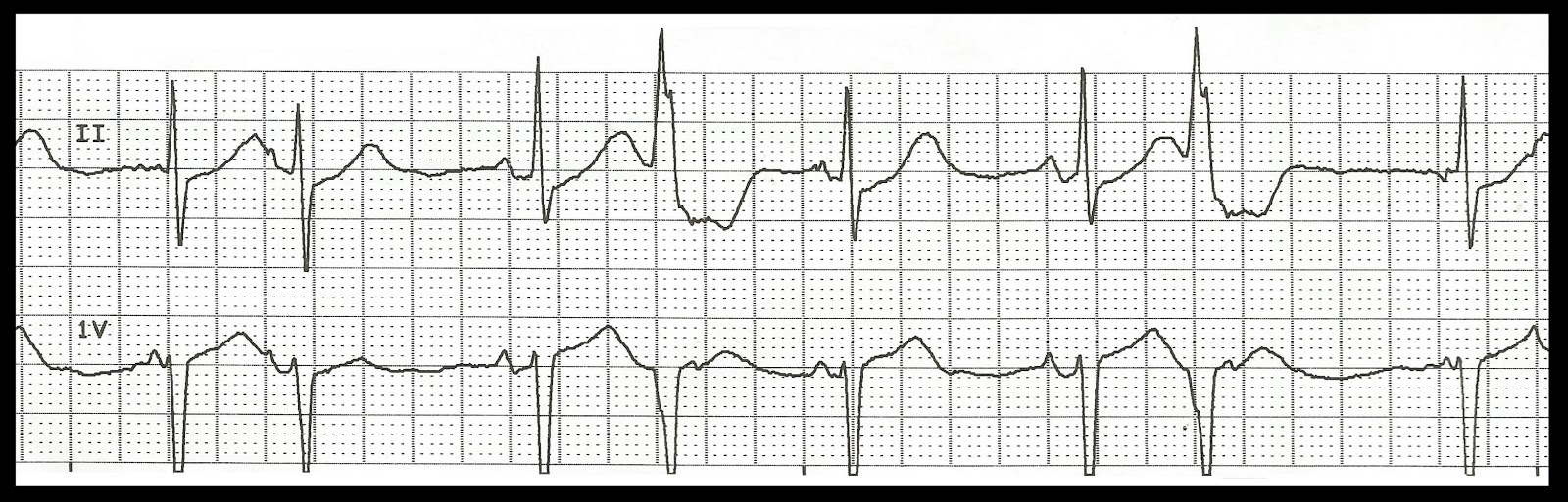 Practice EKG Rhythm Strips 144: Various Escape Beats