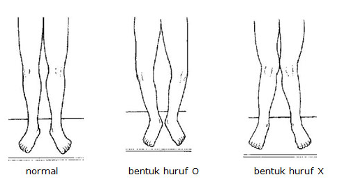 Kelainan dan Gangguan pada Tulang - Biologi Edukasi: Belajar Sains Biologi